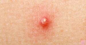 Fungal Acne Vs Closed Comedones: Differences & Best Treatment!