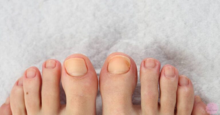 7 Ways How To Fix Ski Jump Toenails And Fingernails At Home!