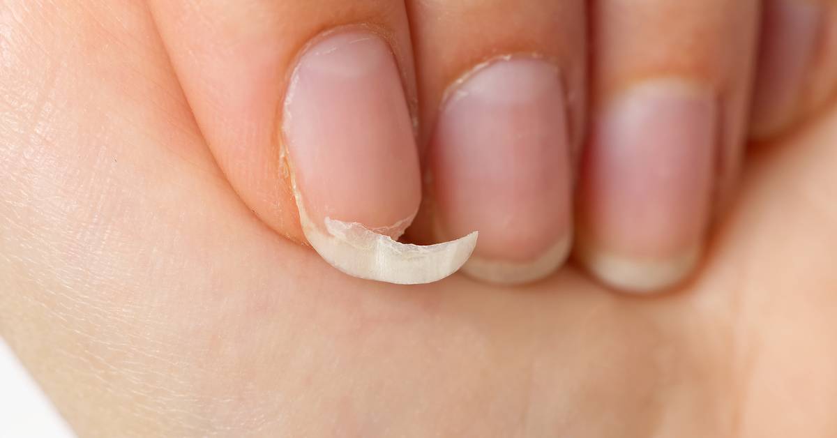 Acrylic Nail Ripped Off Real Nail: How To Speed Up Regrowth